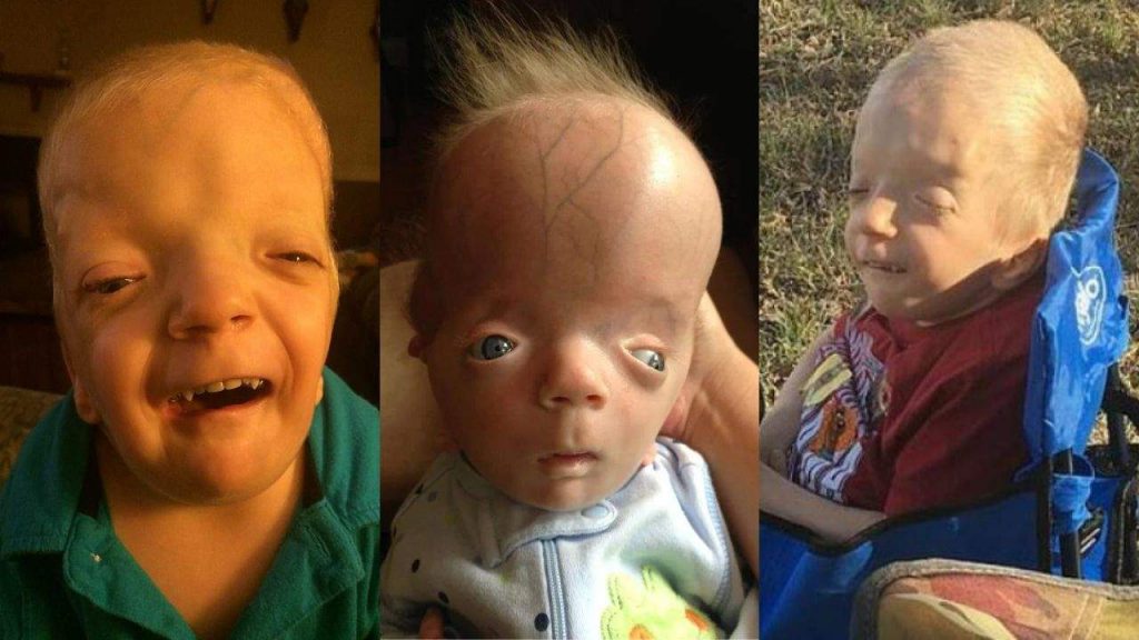 Tragic Story of Grayson Kole Smith - Boy With Rare Birth Defects ...
